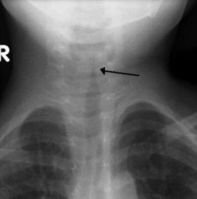 The Scoop on Croup and Its Signature Barking Cough - PediaWise